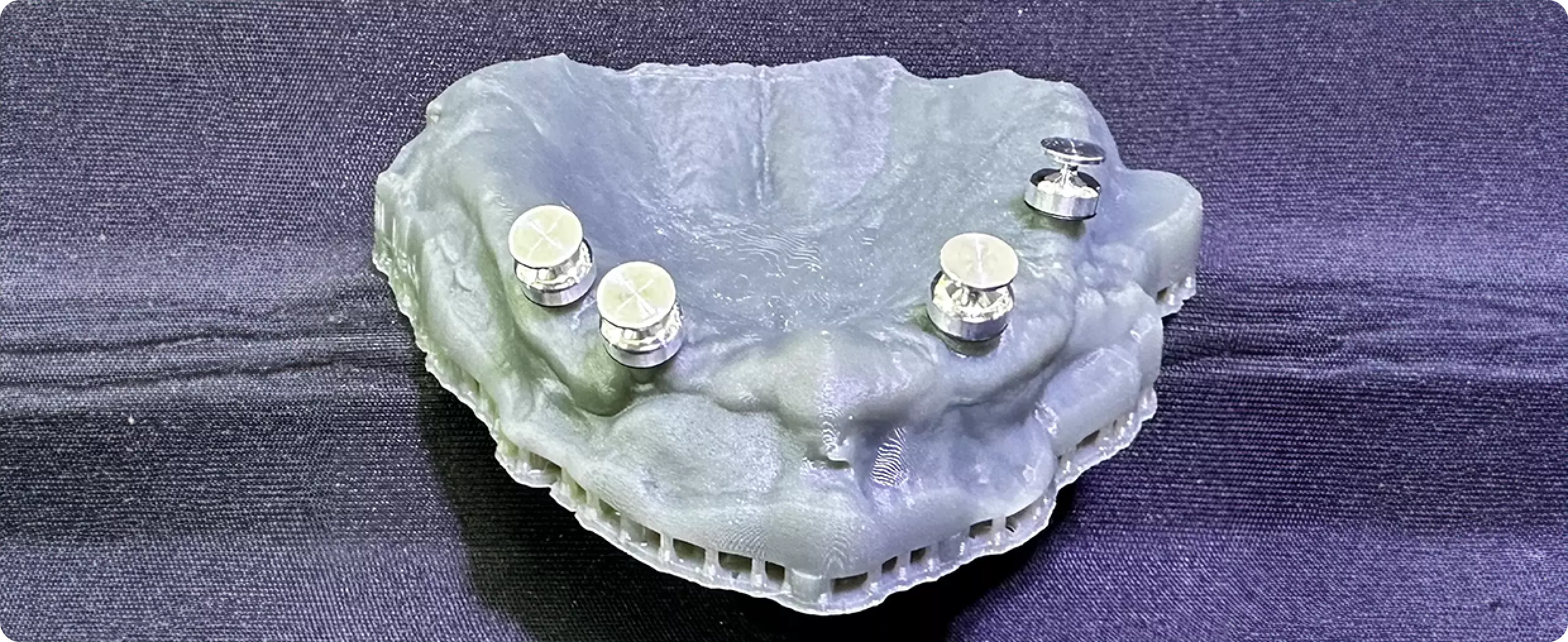 Benefits of Dental Implants Over Dentures | Denture Clinic Kedron